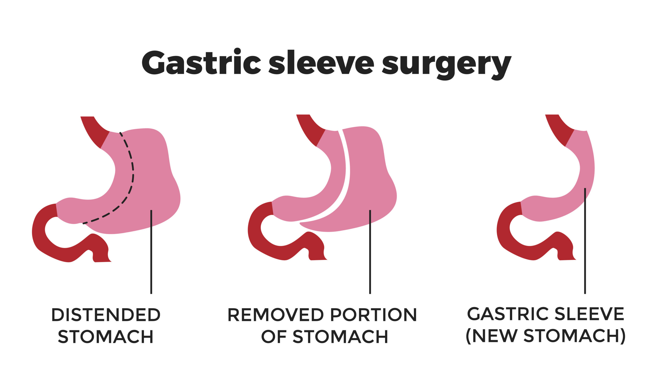 Gastric Sleeve Surgery: Frequently Asked Questions - Blackrock WeightCare